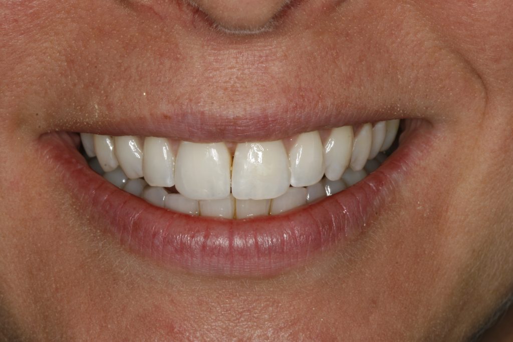 Cherry Tree Dental Care - Teeth Whitening - The Does and Don't